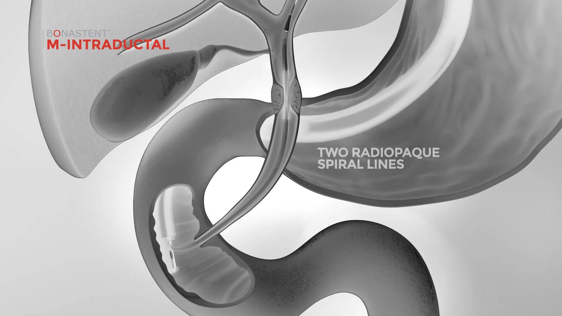 Bonastent® M-Intraductal-Stent – Anwendungsvideo on Vimeo