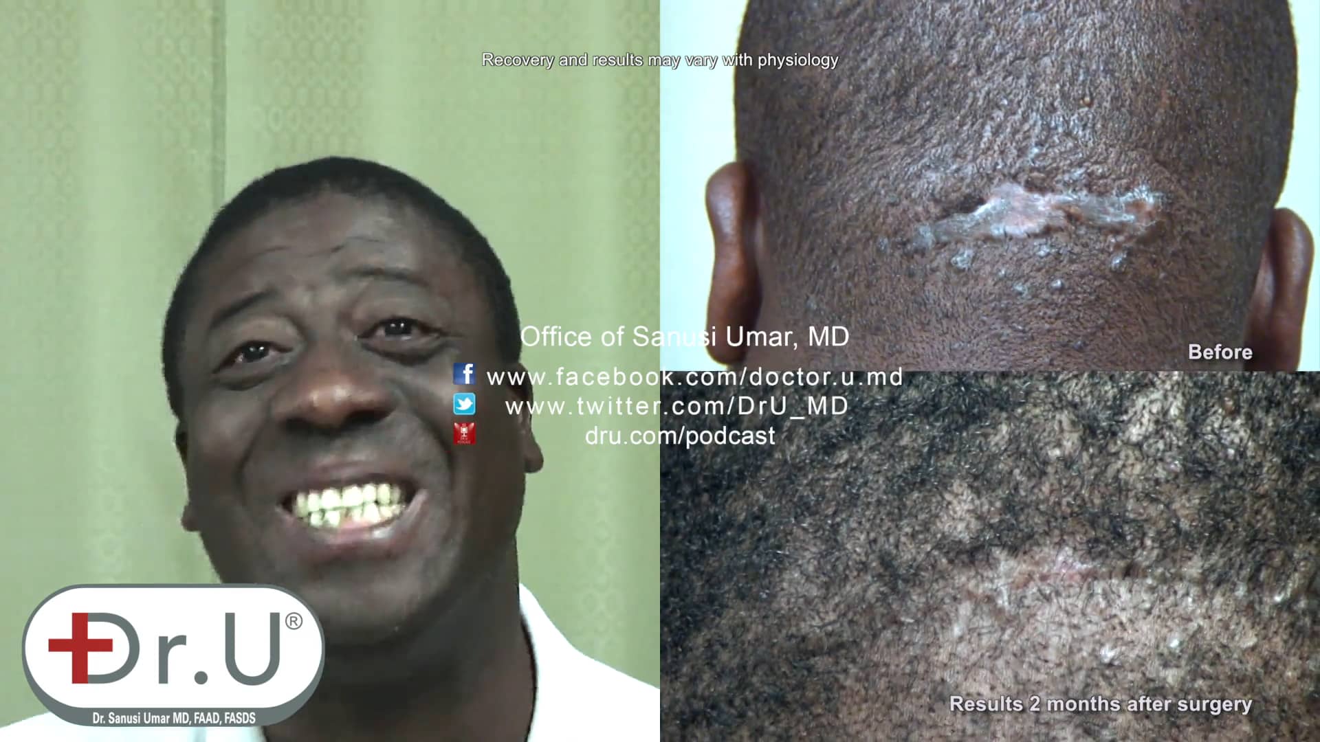 Dr.U's Surgical Removal of AKN Bump For Thin Scar and Hair Concealment ...