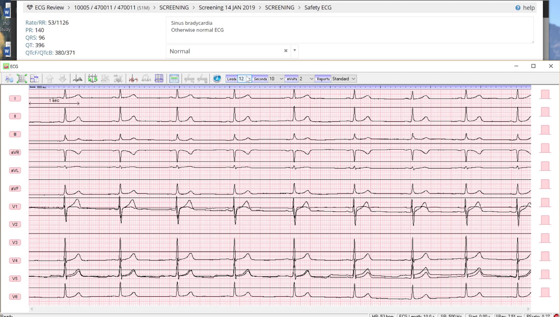 ClinSpark Demo - ECGs (FAQ - CalECG) on Vimeo