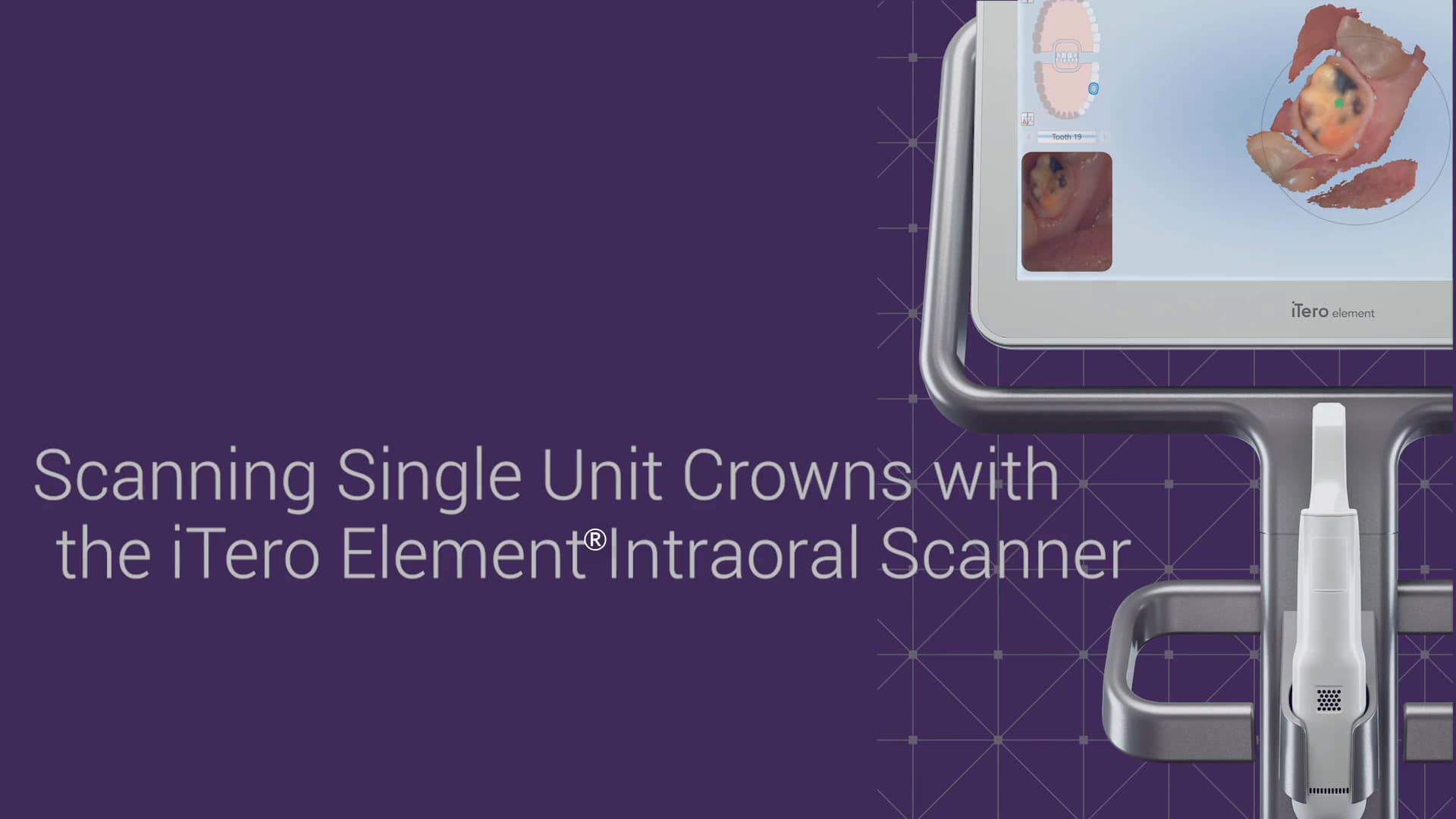 Scanning Single Unit Crowns with the iTero Element® Intraoral Scanner ...