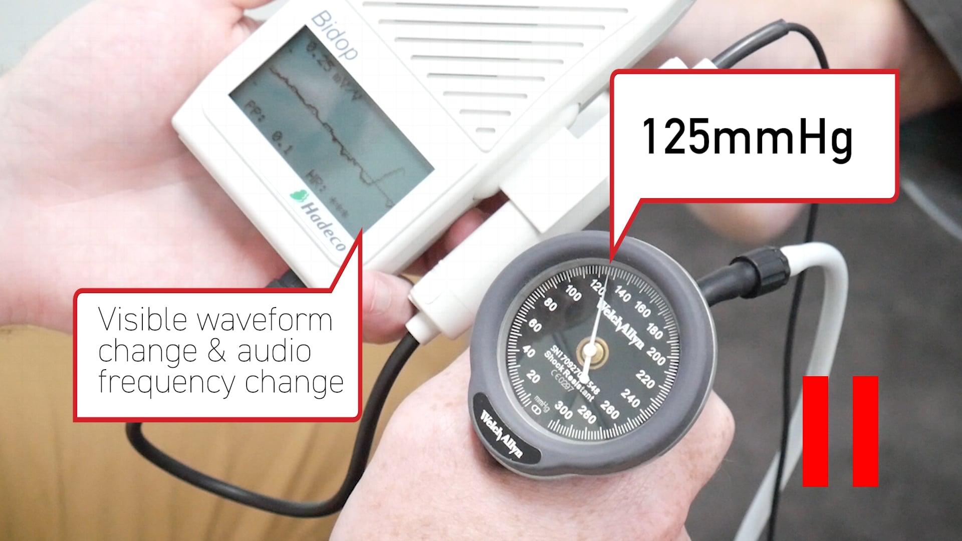Obtaining Toe Pressures with the Hadeco ES100V3 on Vimeo