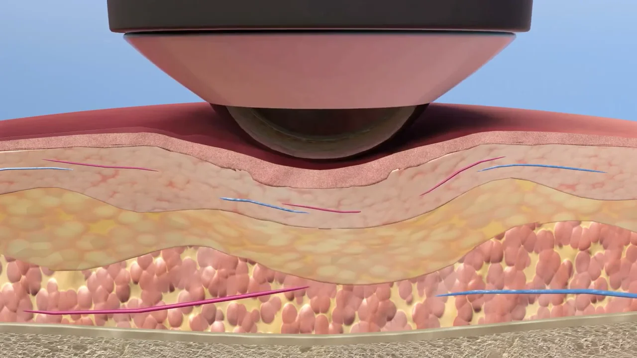 Companion Therapy Laser by LiteCure - 3D Medical Animation