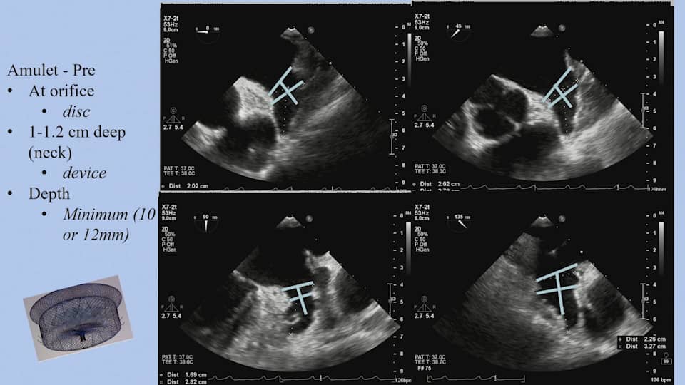 TEE for LAAC: Watchman and Amulet Before, During and After the ...