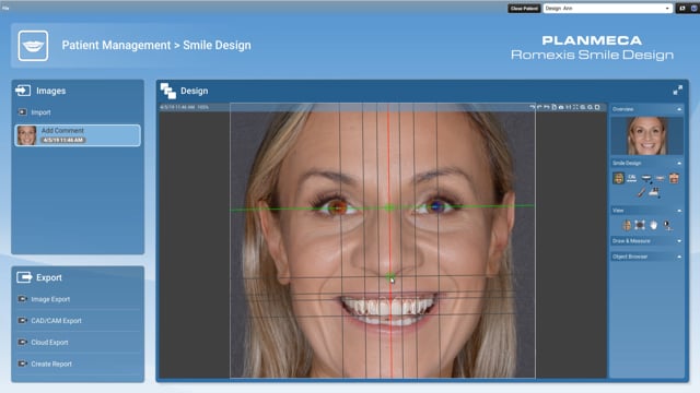Planmeca Romexis Smile Design on Vimeo