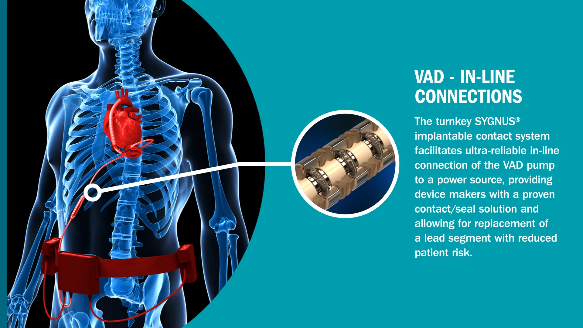 Bal Seal Engineering: Electrical Contact Technology for Medical Active ...