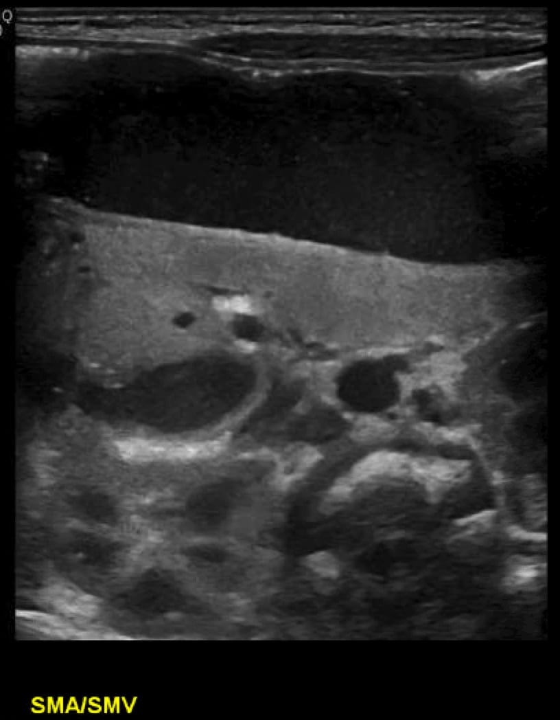 Whirlpool or swirl sign is consistent with volvulus on Vimeo