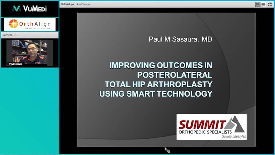 HipAlign (lateral approach) - Improving Posterolateral THA Outcomes ...