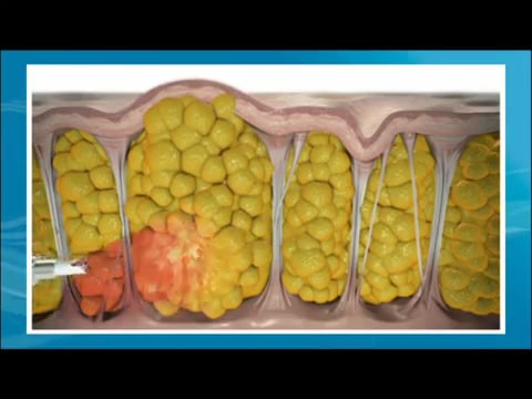 Cellulaze laser for cellulite on Vimeo