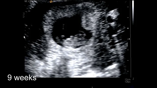 9 Week Ultrasound Identical Twins