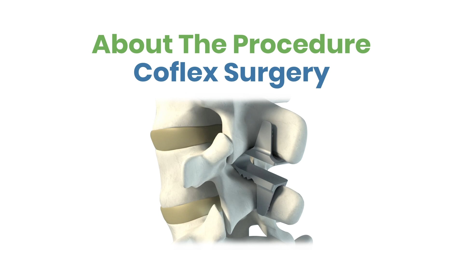 Coflex Interlaminar Stabilization Surgery on Vimeo