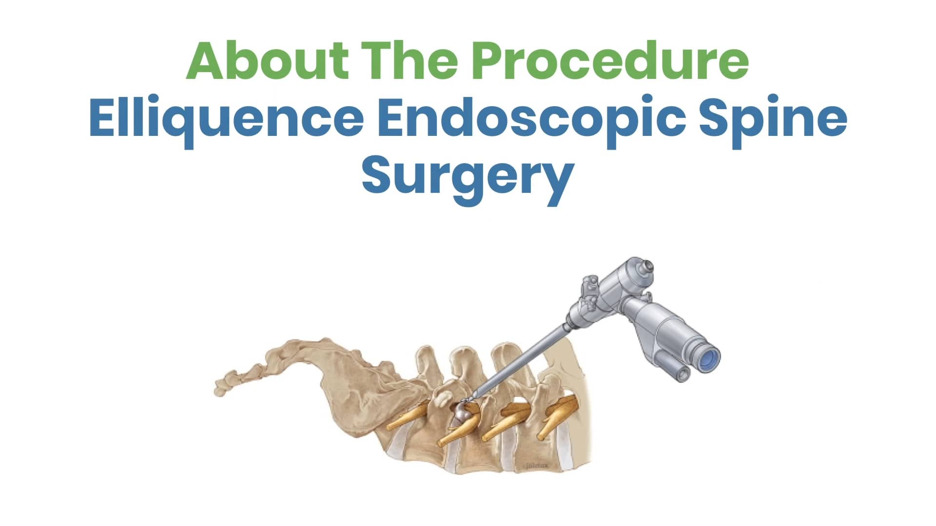 Elliquence Endoscopic Spine Surgery on Vimeo