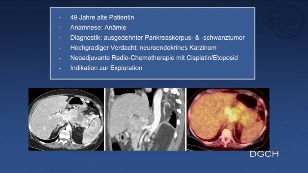Appleby Operation bei ausgedehntem Pankreaskorpus- und -schwanztumor ...