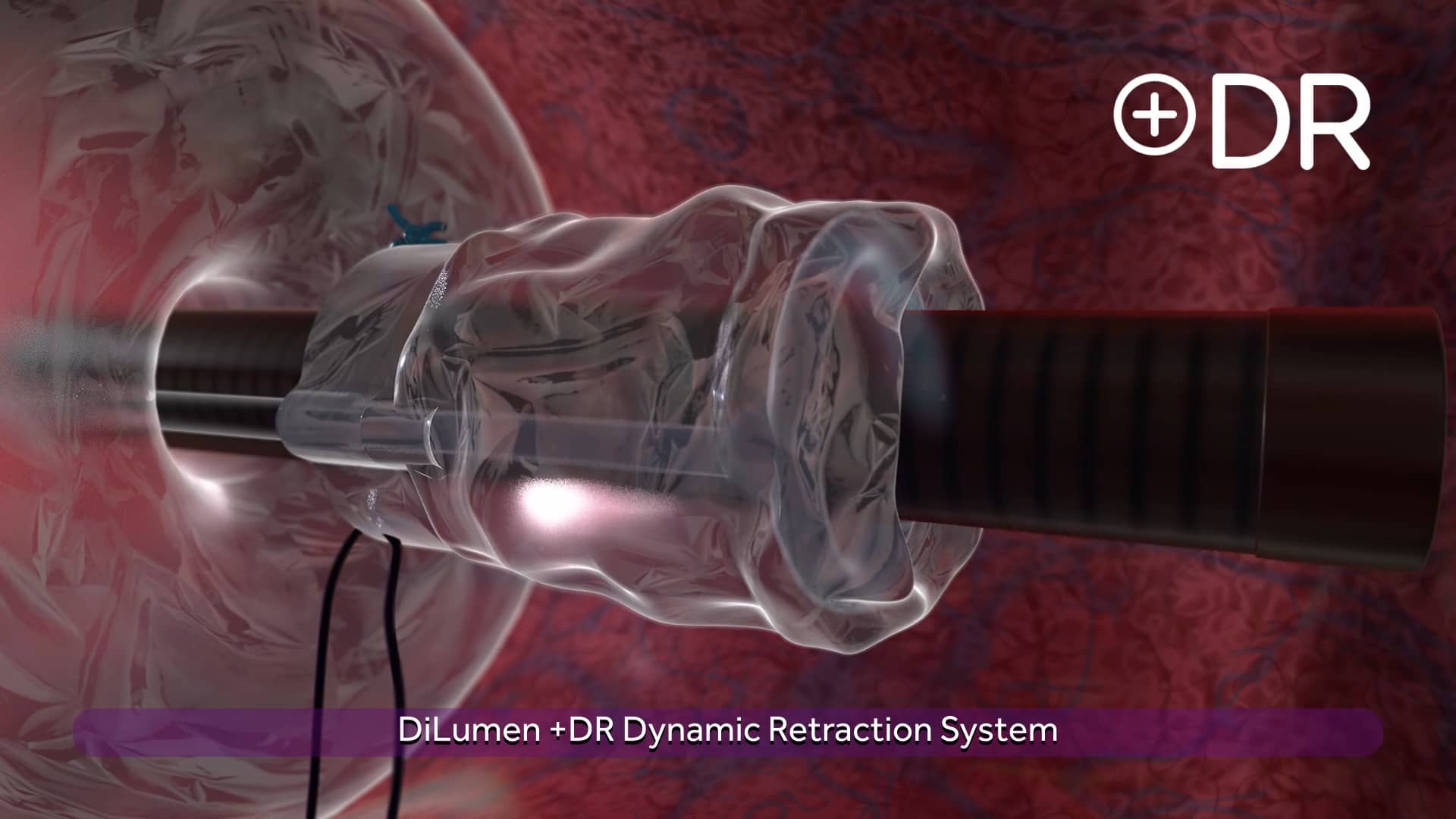 Lumendi: DiLumen EIP on Vimeo