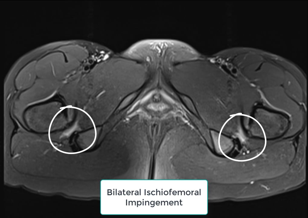 Bilateral Ischiofemoral Impingement on Vimeo