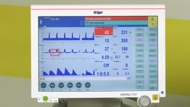 Patient-Ventilator Interactions with the ASL 5000 Breathing Simulator ...
