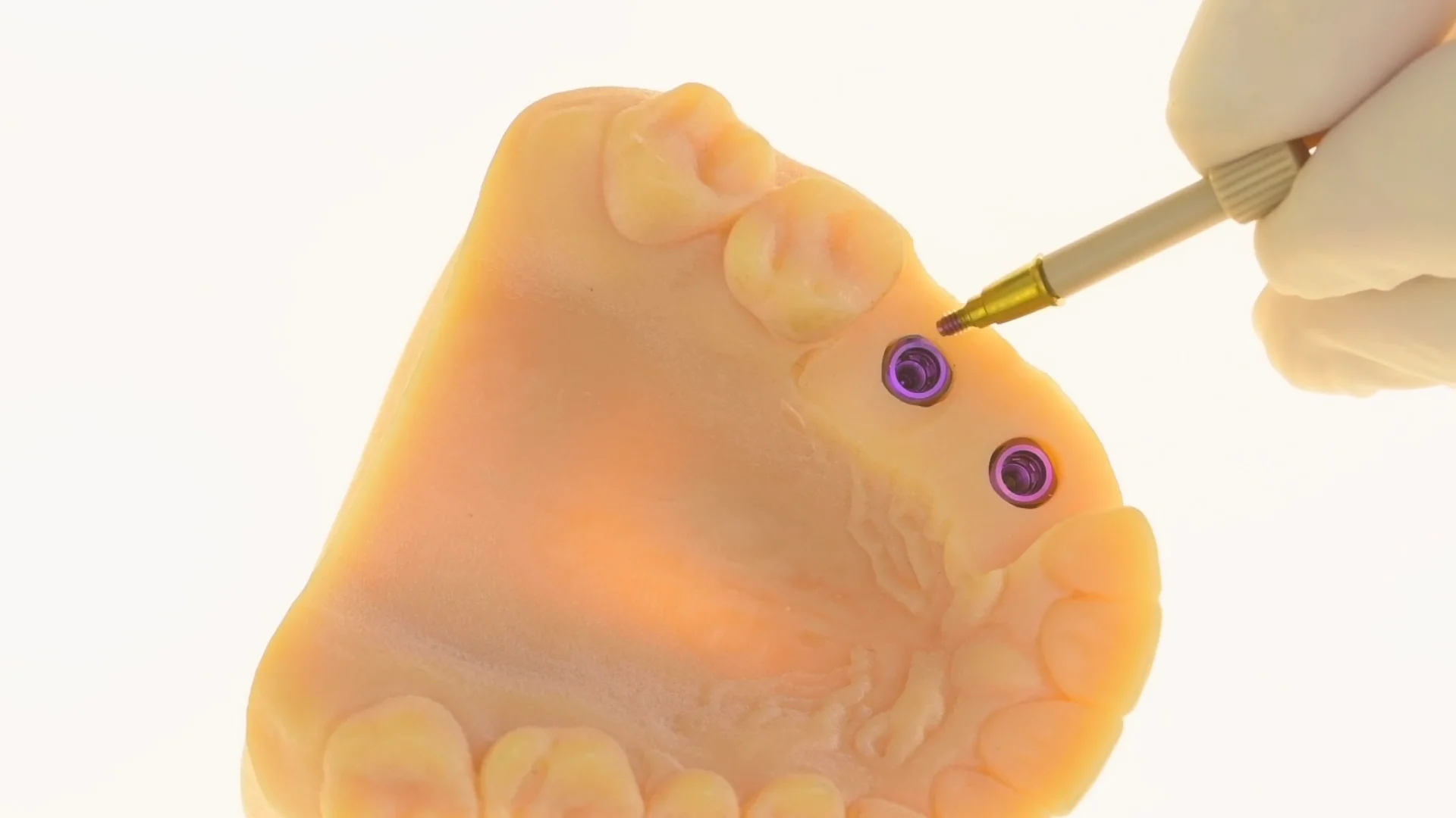Using the MIS CONNECT Abutment