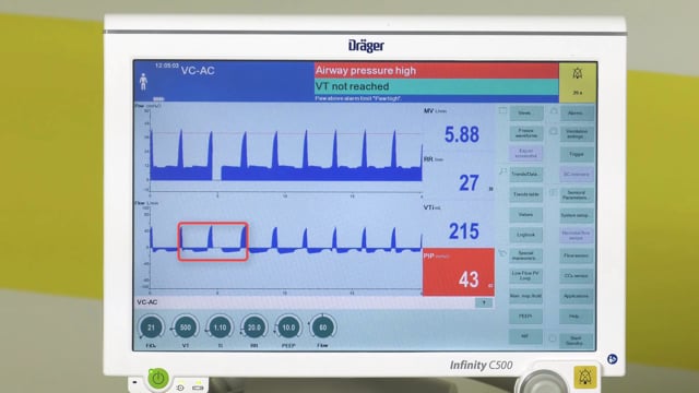 Patient-Ventilator Interactions with the ASL 5000 Breathing Simulator ...