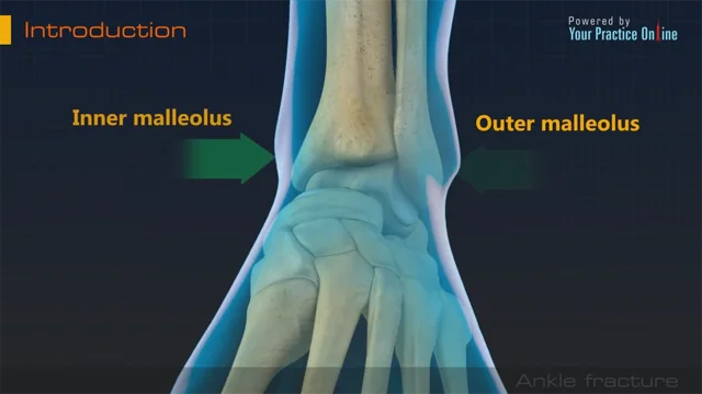 Medial Malleolus Fracture