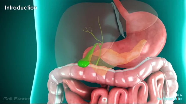 Real Gallbladder Stones