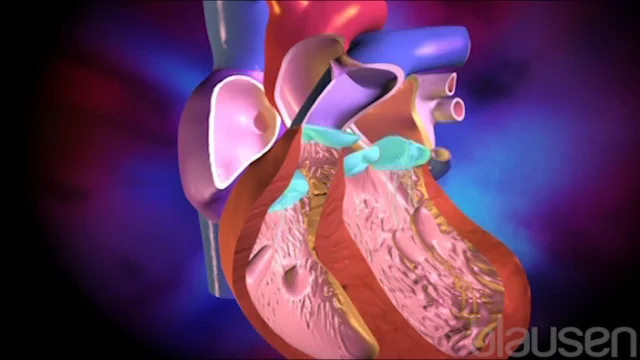Patent Ductus Arteriosus Animation