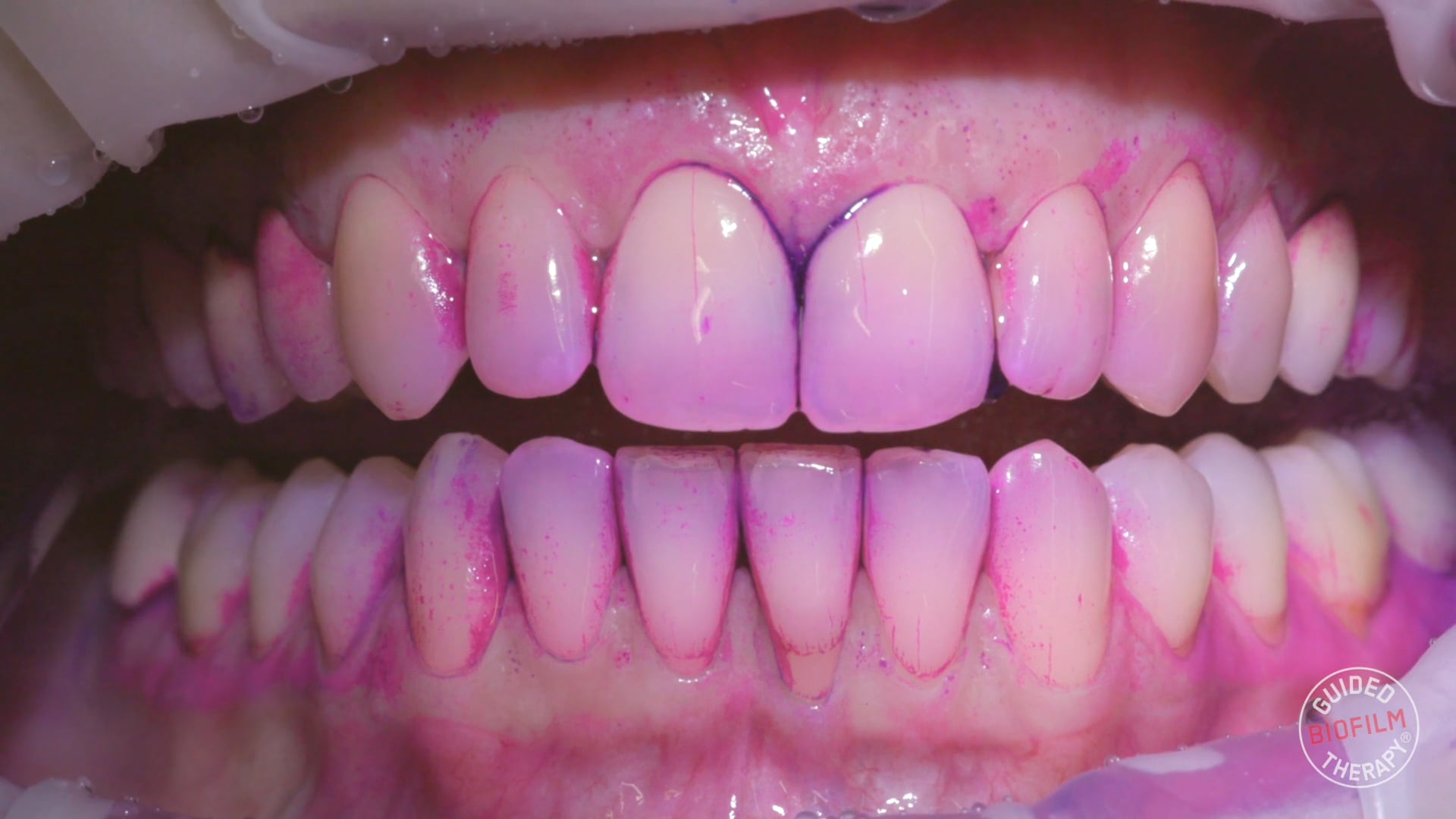 Professional tooth cleaning on a healthy patient with GBT (Guided ...