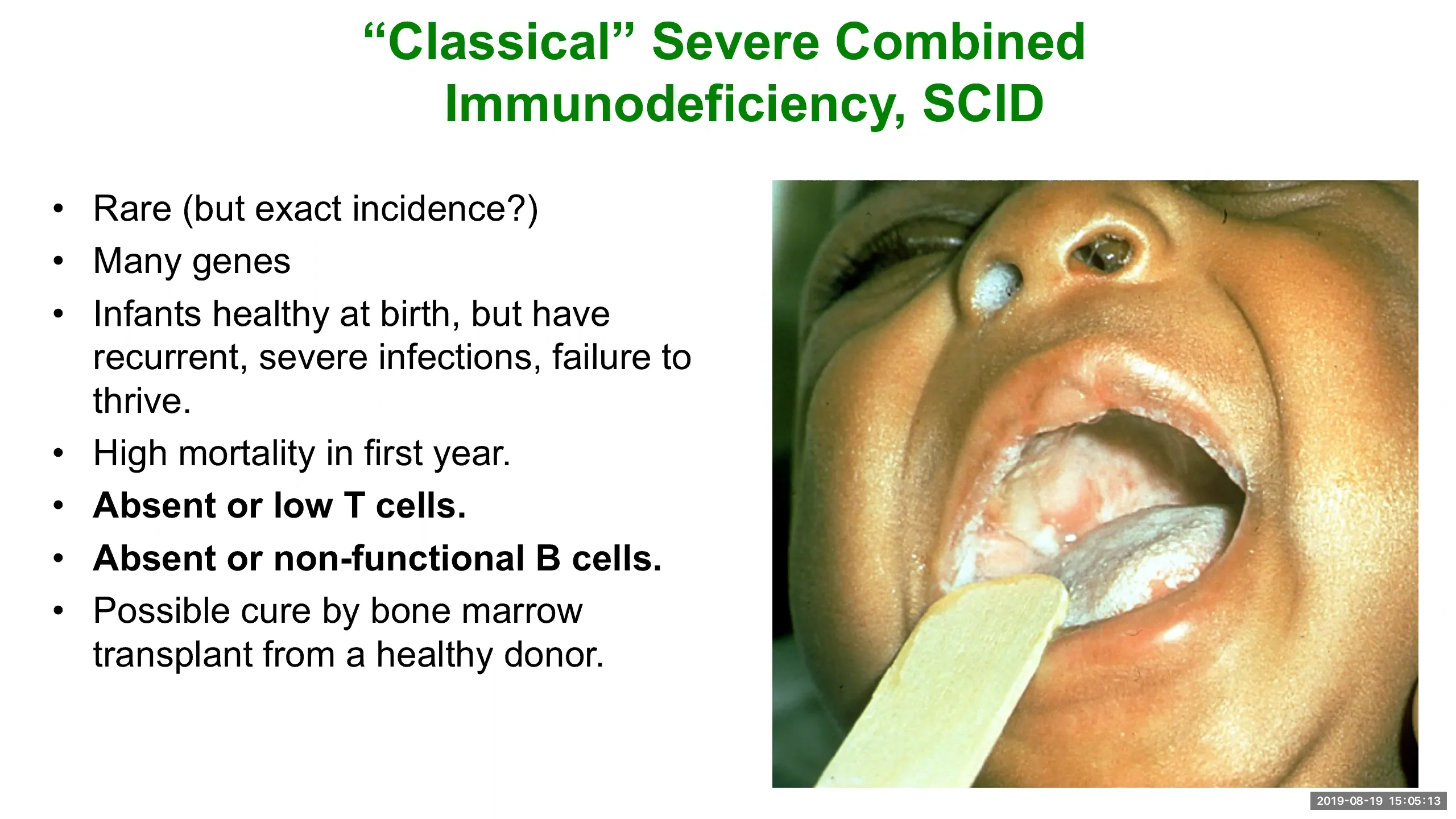 Severe Combined Immunodeficiency (SCID) National Quarterly Webinar ...