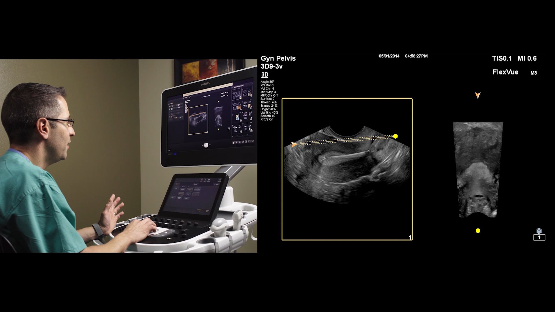 Philips_FlexVue_Intensity_Projections Clip on Vimeo