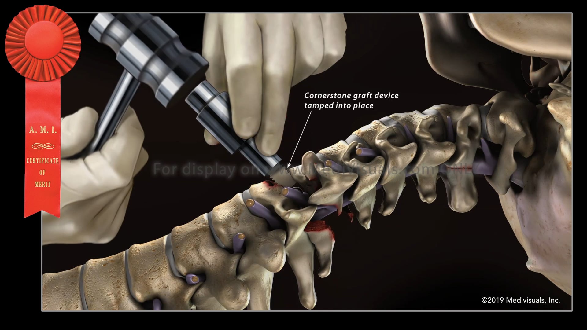 2019 AMI- Cervical Spine Injures, Gardner Wells Tongs Placement ...