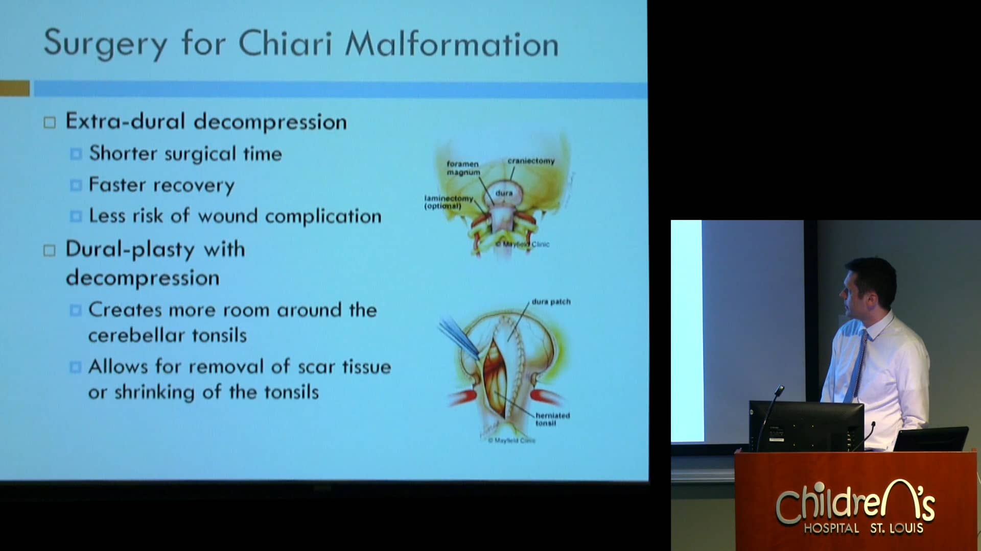 "Chiari Malformation, Chiari Decompression and Neurosurgery" - Sean ...