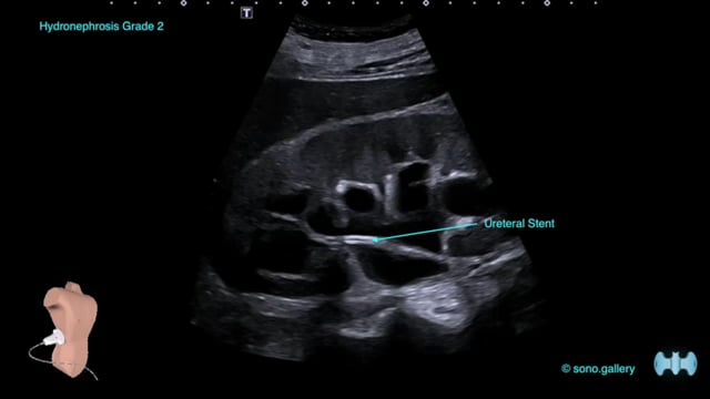 Hydronephrosis Grade 2/3, Ureteral Stent - SONO.GALLERY