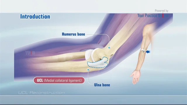 Ulnar Collateral Ligament Injury