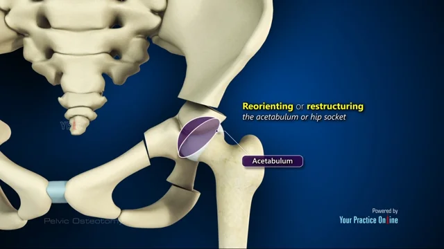 Periacetabular Osteotomy Super Quality | www.meesenburg.kz
