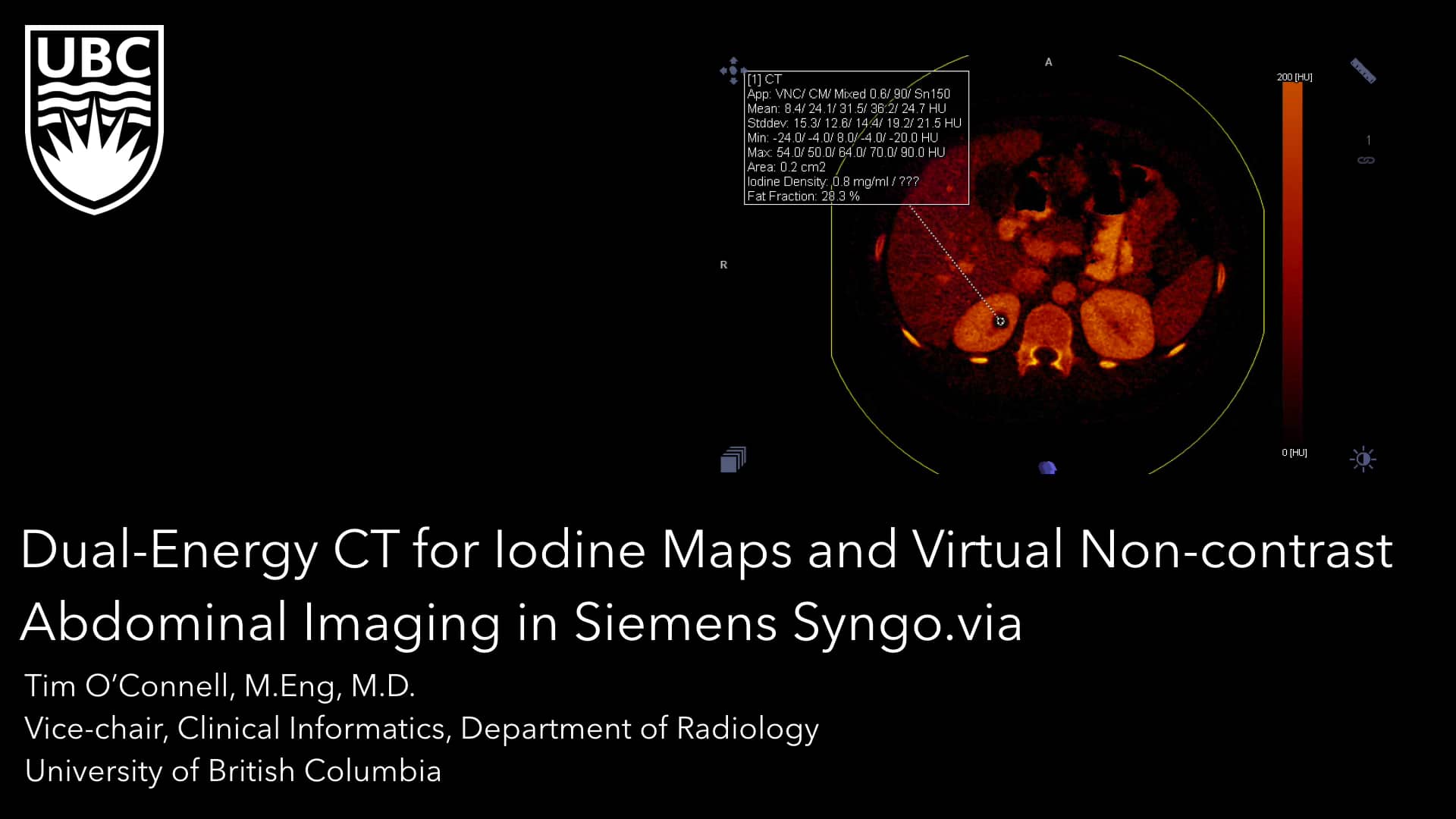Using Syngo.via to Create Iodine Maps and Virtual Non-contrast Images ...
