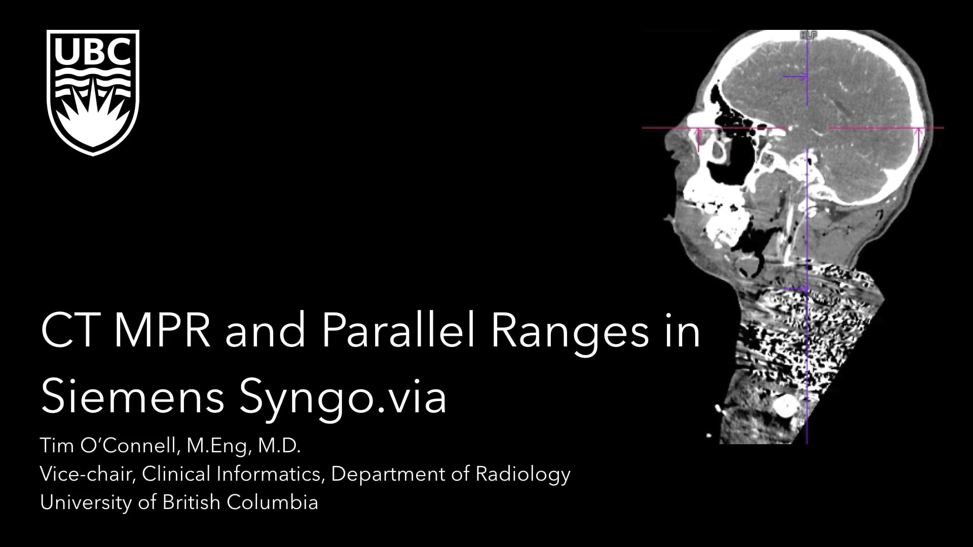 CT MPR and Parallel Ranges in Siemens Syngo.via on Vimeo