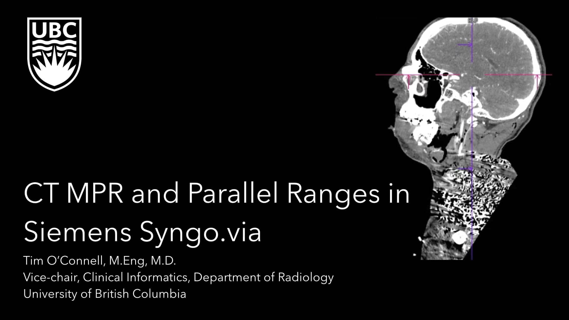 CT MPR and Parallel Ranges in Siemens Syngo.via on Vimeo