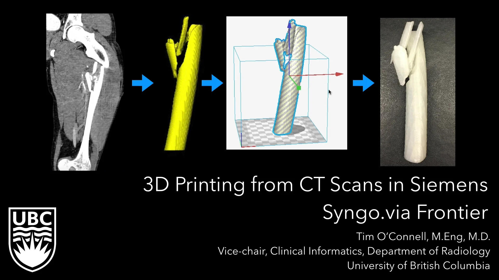 3D Printing from CT Scans in Siemens Syngo.via Frontier
