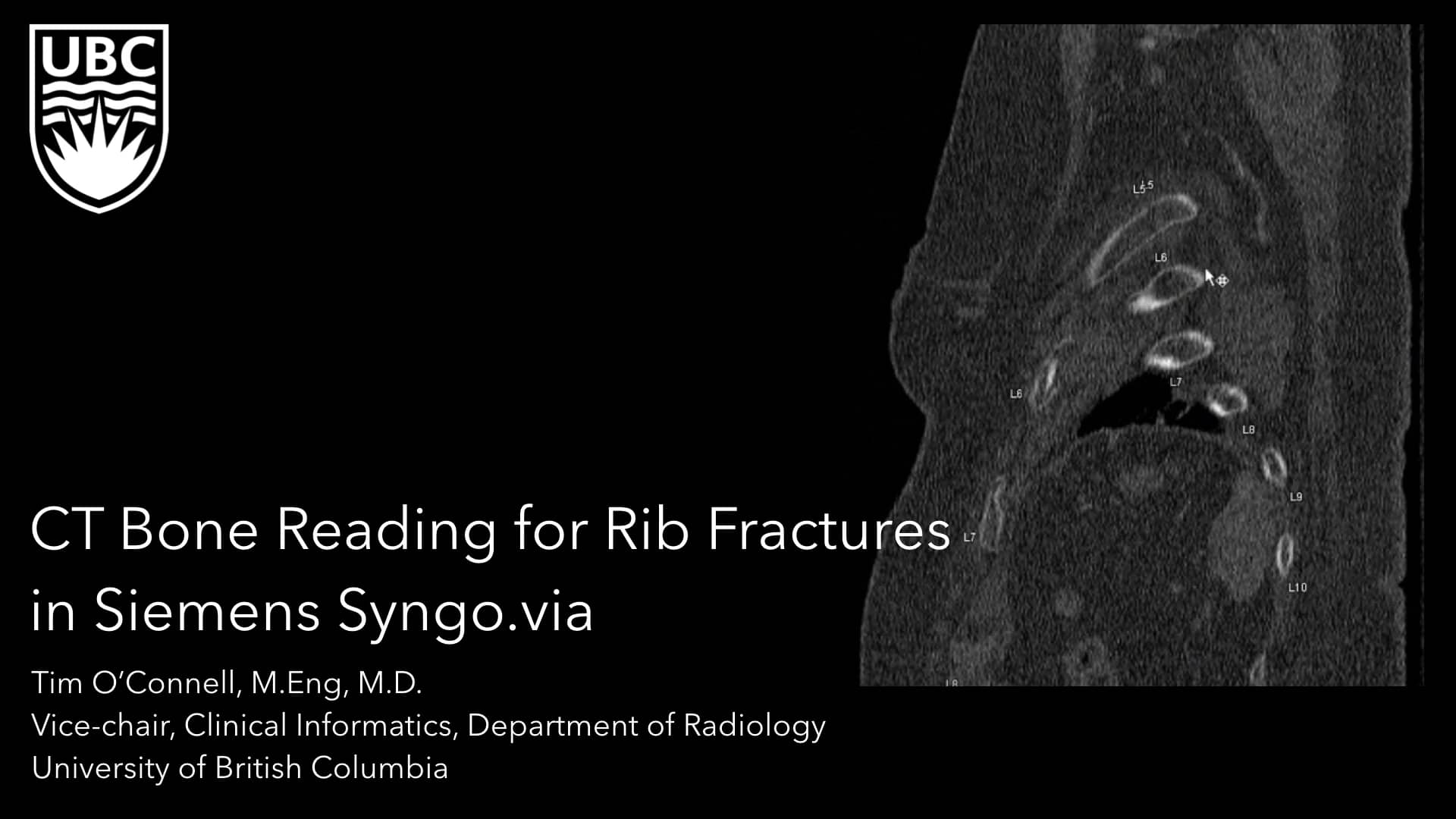 CT Bone Reading for Rib Fractures in Siemens Syngo.via on Vimeo