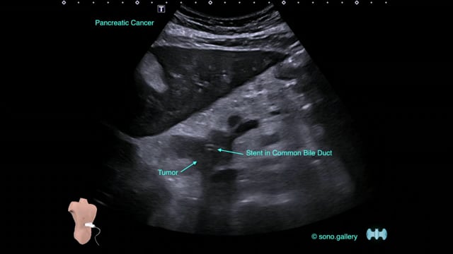 pancreatic cancer (proc. uncinatus) - SONO.GALLERY