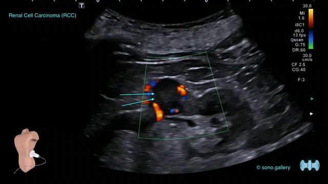 Renal Cell Carcinoma (RCC) - SONO.GALLERY