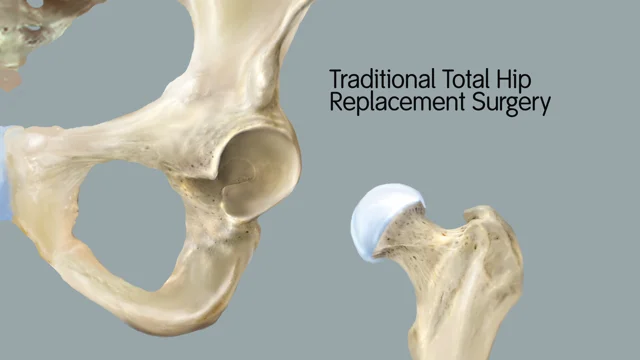 Birmingham Hip Resurfacing Complications