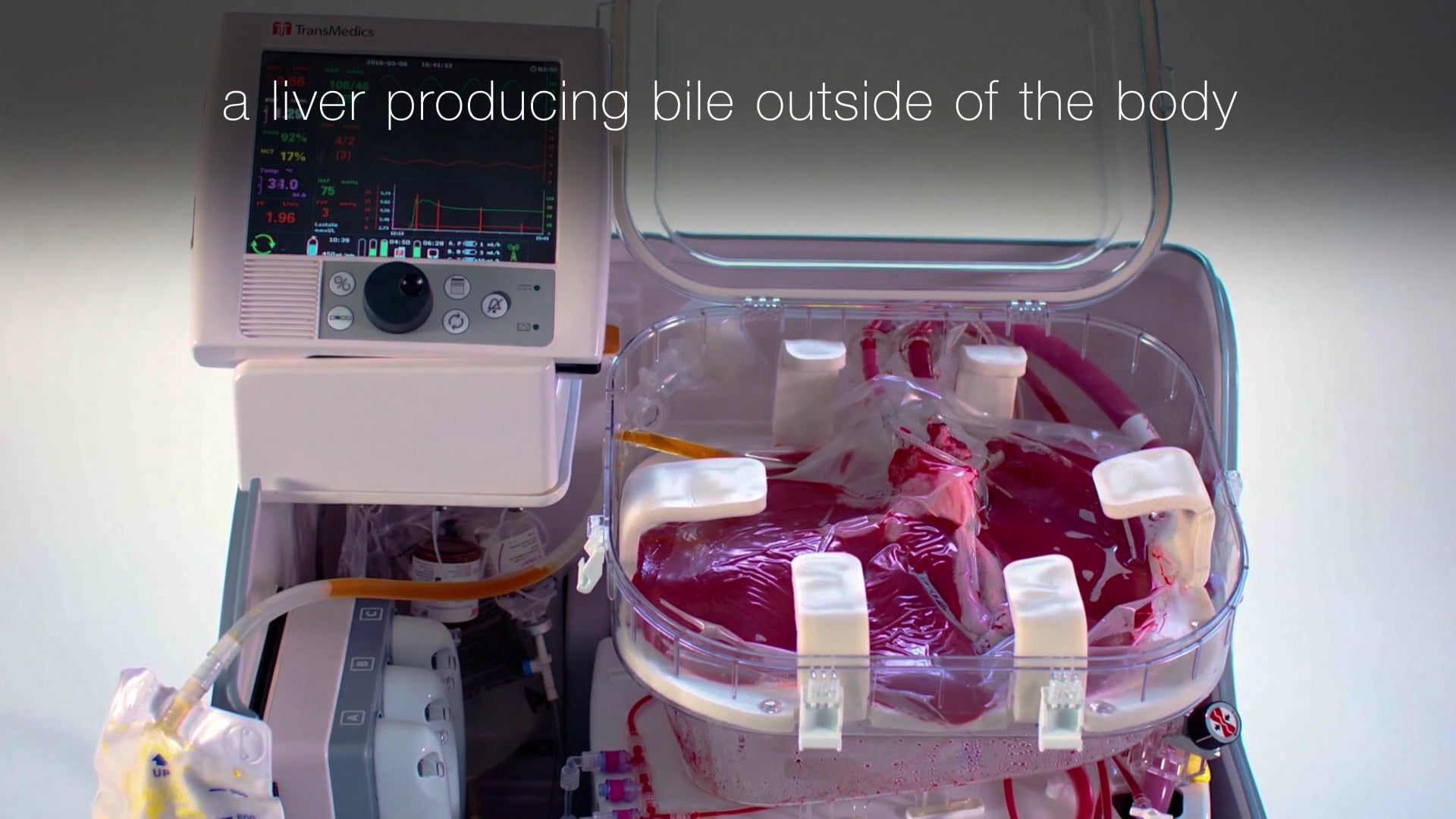 TransMedics: Redefining Organ Transplantation on Vimeo