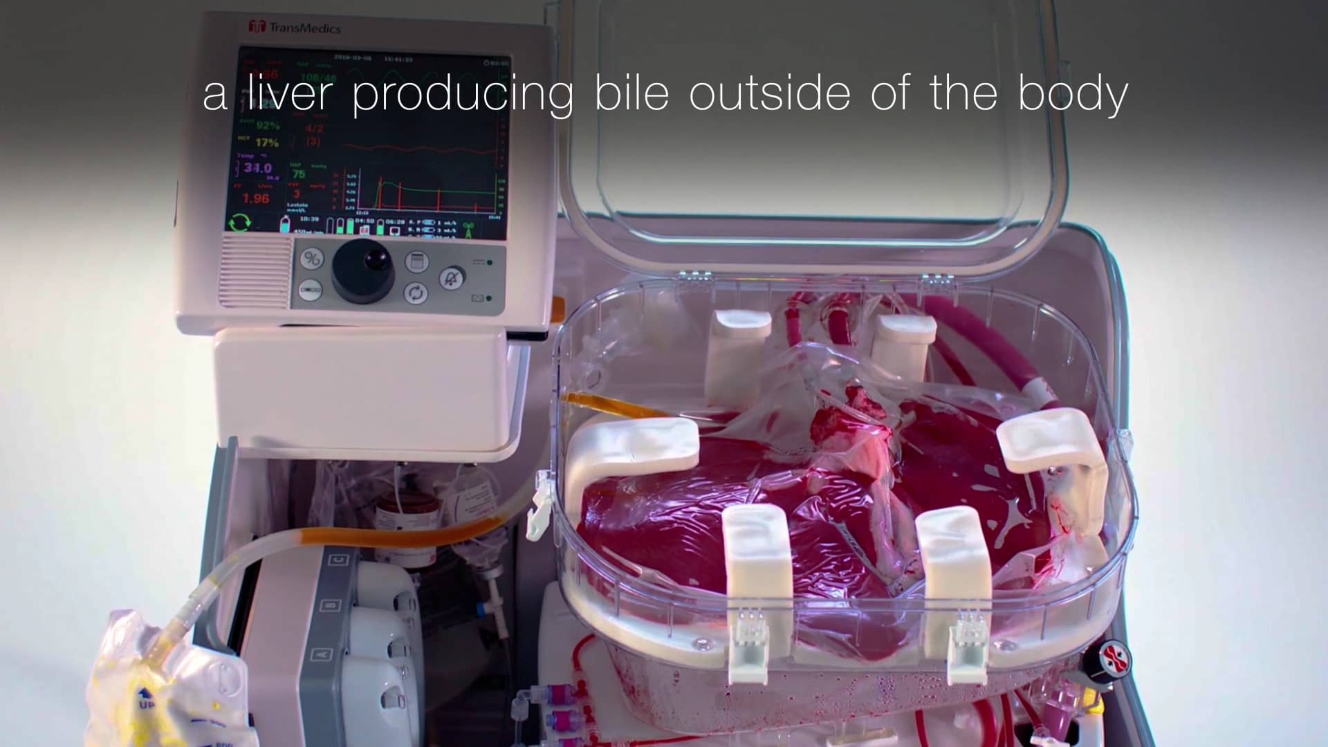 TransMedics: Redefining Organ Transplantation on Vimeo