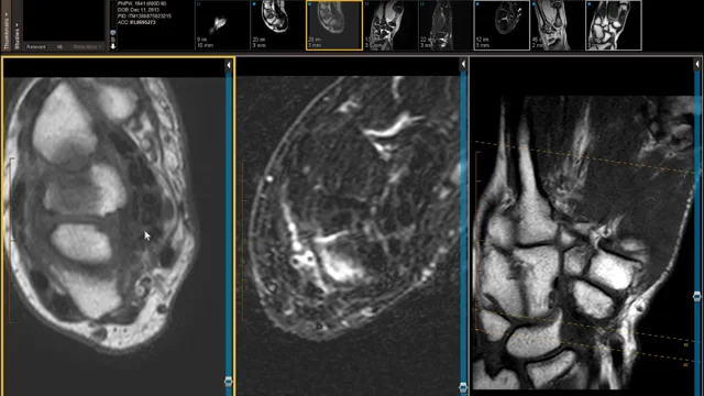 Flexor Pollicis Longus Mri