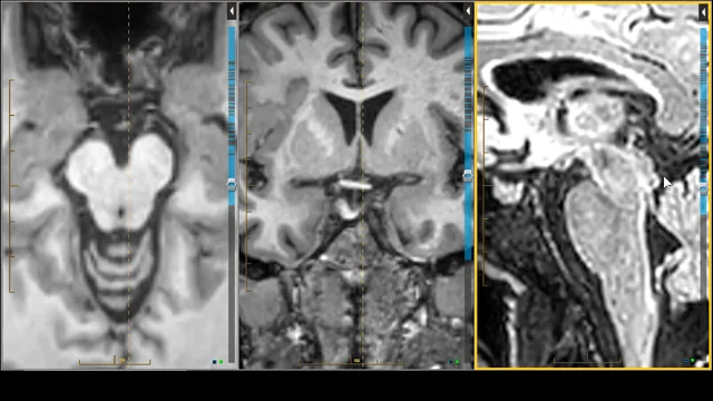 Trochlear Nerve Mri