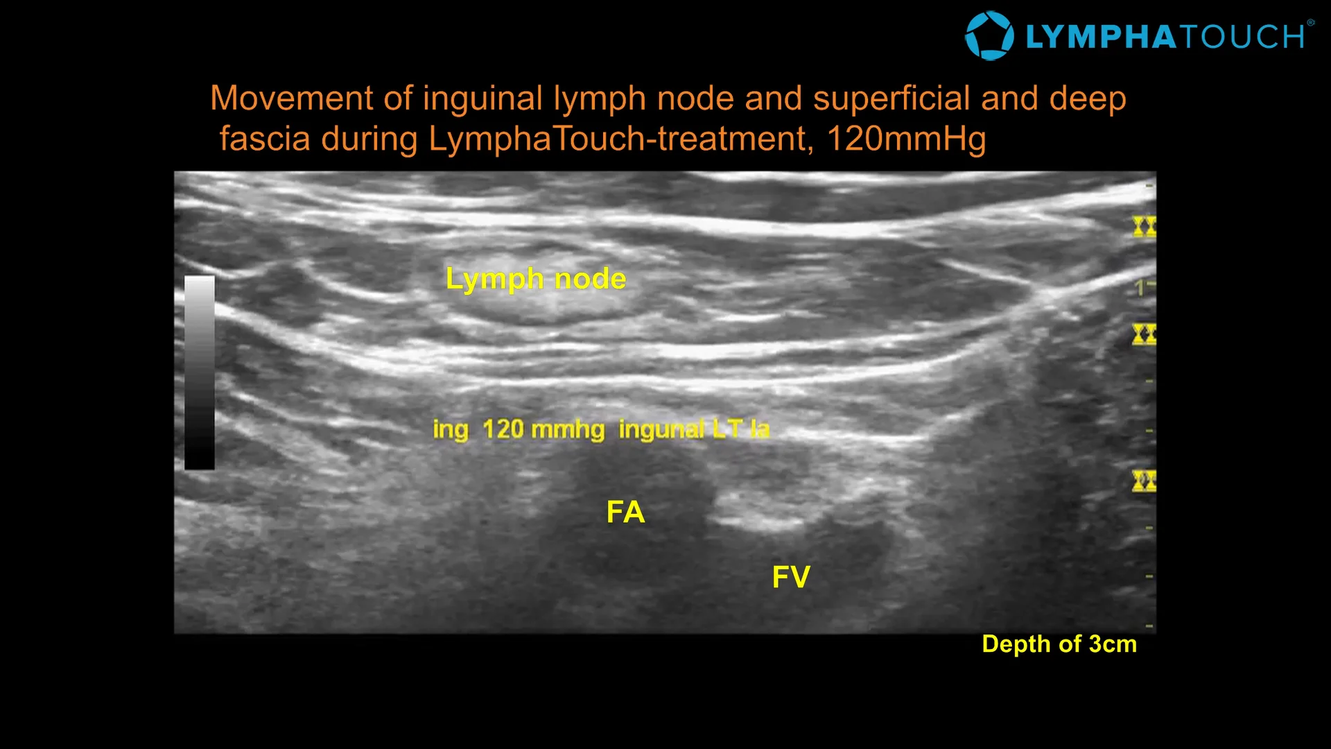 Superficial Inguinal Lymph Nodes