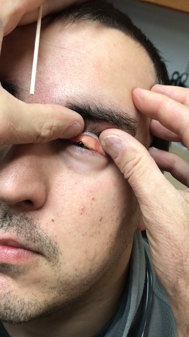 Eyes: Lid Eversion Procedure on Vimeo