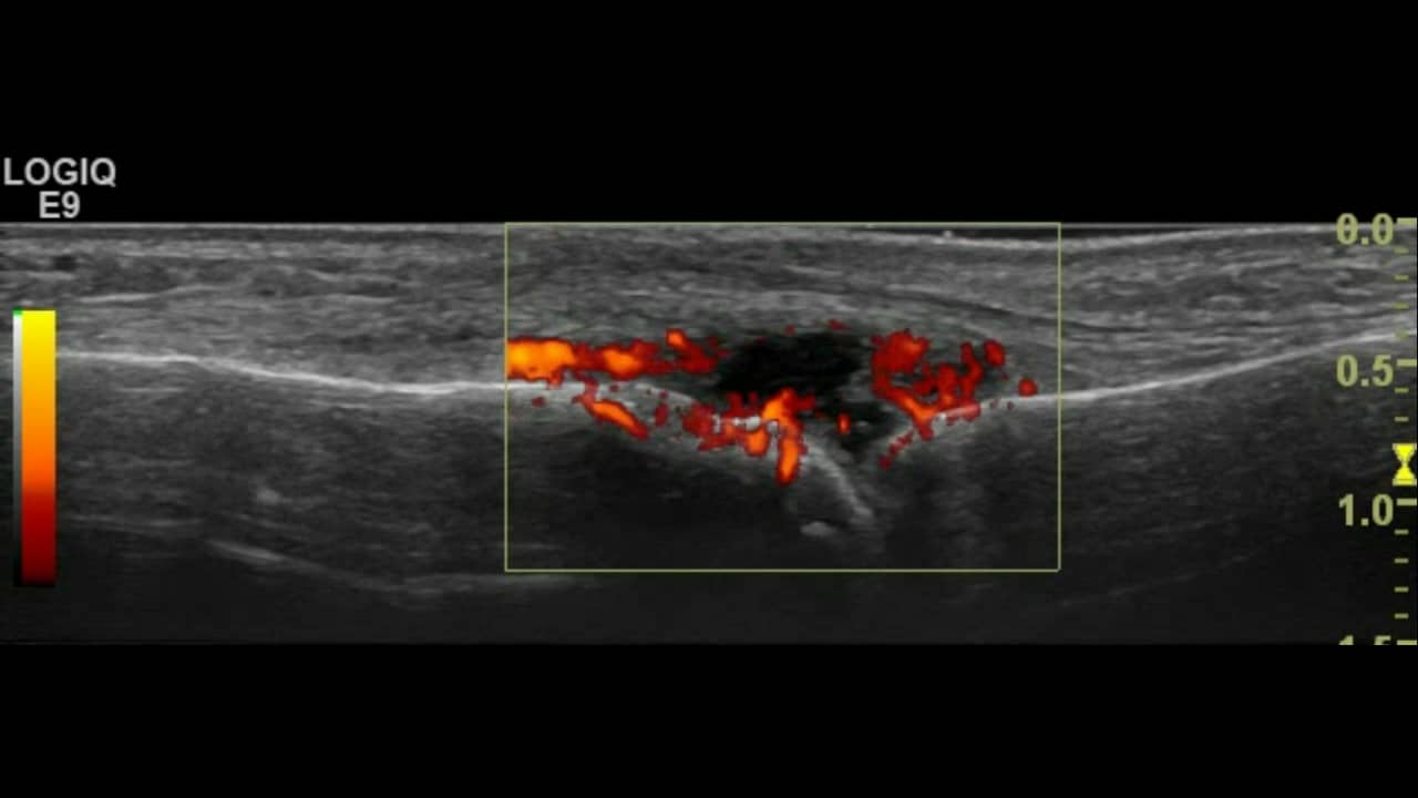 hand finger mcp synovitis effusion doppler on Vimeo