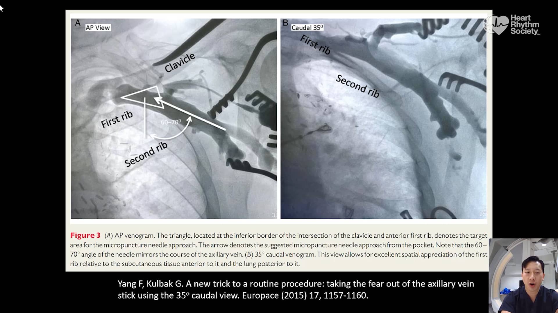 Expert Perspective: Felix Yang, MD, FHRS, CCDS, discusses part 1 of ...