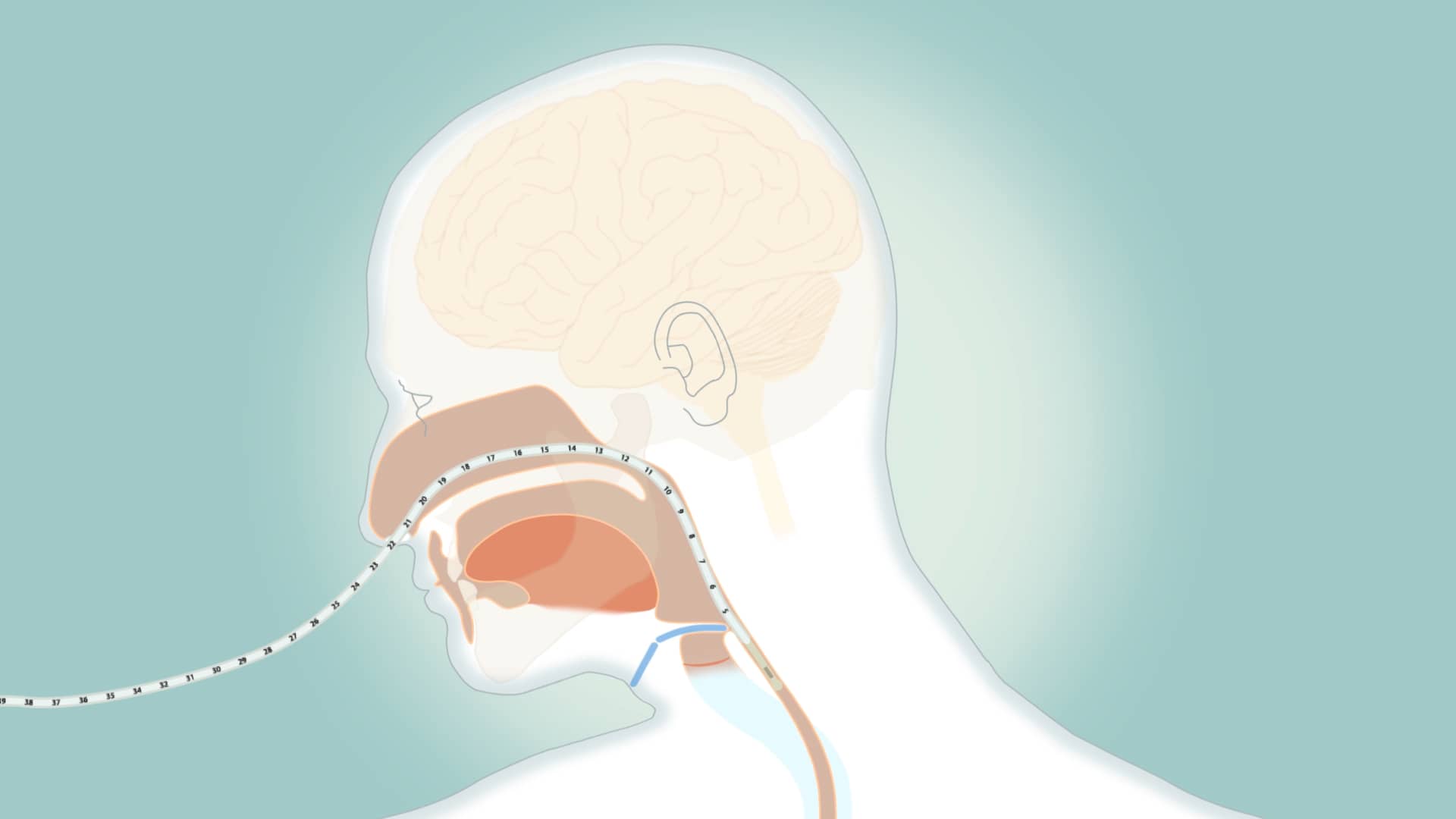 Het inbrengen van een neusmaagsonde on Vimeo