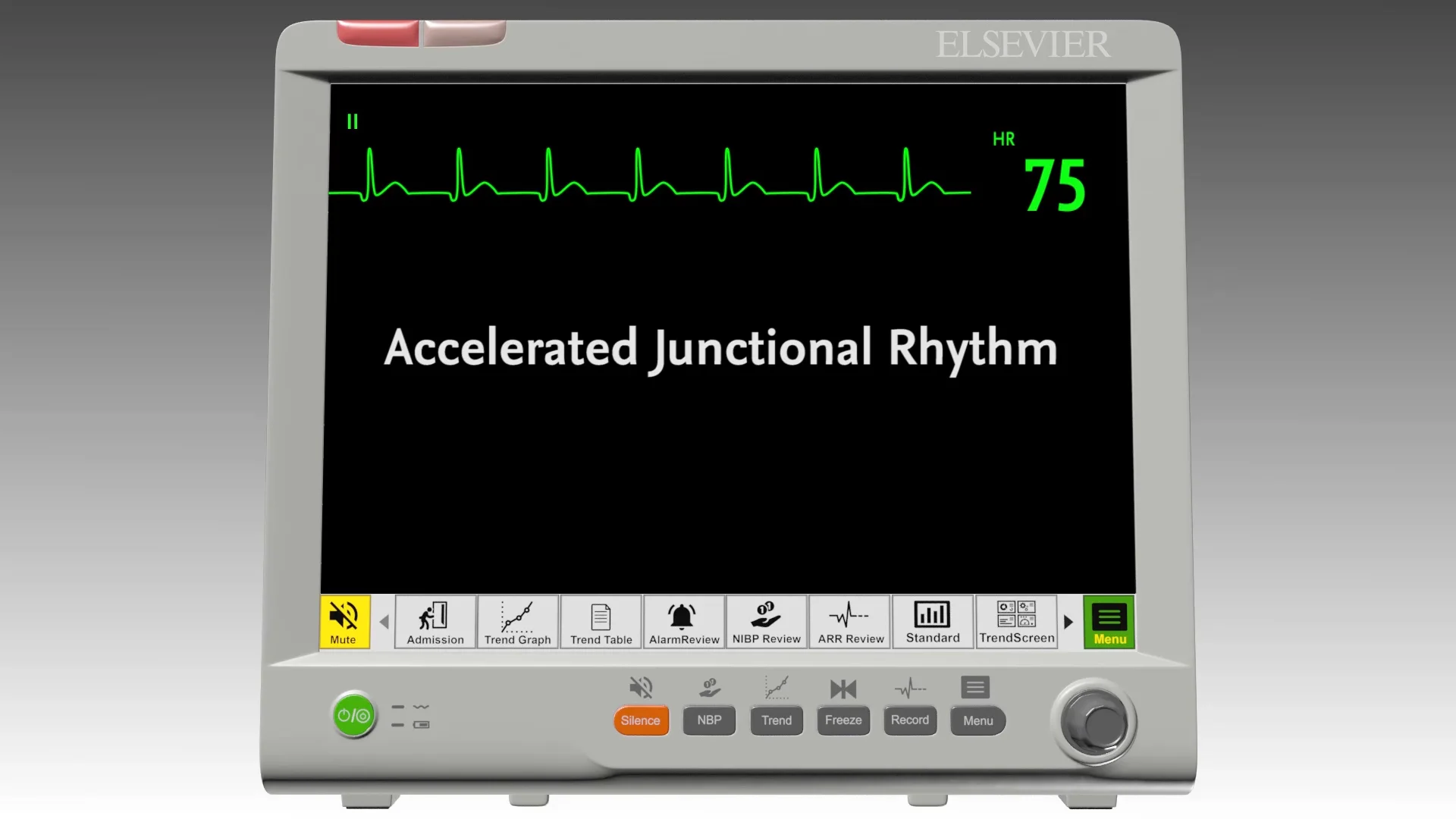 ECG Monitors - Accelerated Junctional Rhythm on Vimeo